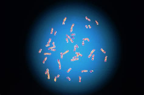 Turner Syndrome Karyotype Photograph By Gjlpscience Photo Library Pixels
