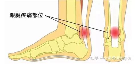 冉冉科普 为什么你会得跟腱炎得了跟腱炎该怎么办 知乎