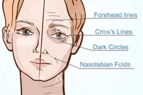 思伊美玻尿酸型号大全lines至润derm至柔deep至盈plus至瑅sub Skin至极至梵系列各有特点 非常完美
