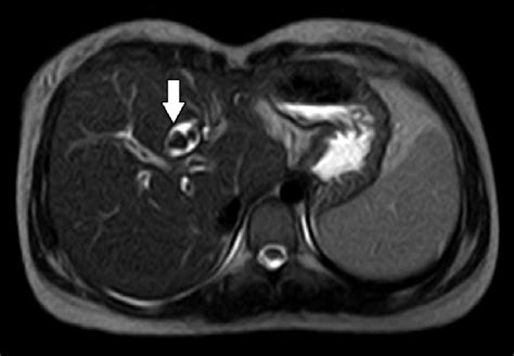 Magnetic Resonance Cholangiopancreatography Normal Anatomy 41 Off