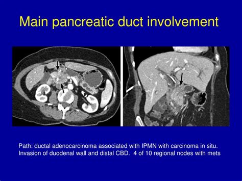 PPT - Intraductal Papillary Mucinous Neoplasms PowerPoint Presentation - ID:4265826