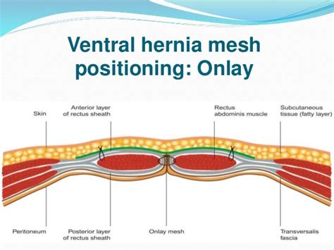 Types Of Mesh And Complications