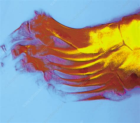Coloured X Ray Of Rheumatoid Arthritis Of A Foot Stock Image M Science Photo Library