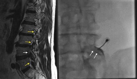 What Is A Spine Block At Archer Nettlefold Blog