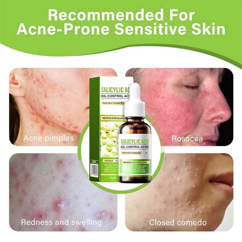 Suero De ácido Salicílico Esencia Suave Facial Antiacné Suero Suave
