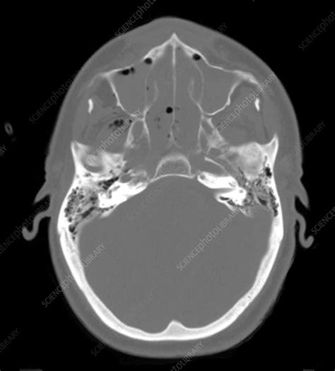 Extensive Traumatic Brain Injury CT Stock Image C027 1680 Science