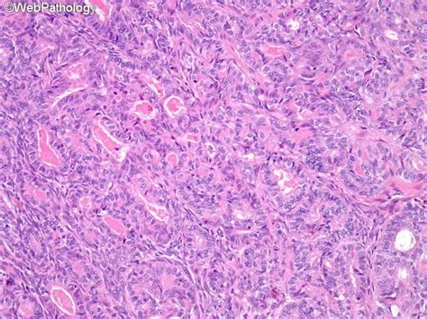Synovial Sarcoma Differential Diagnosis