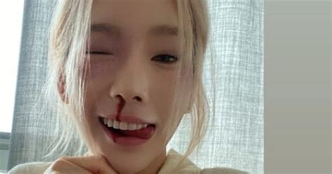 소녀시대 태연 퍼렇게 멍든 눈에 코피가 줄줄 무슨 일 있었나