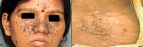 Tuberous Sclerosis Shagreen Patch
