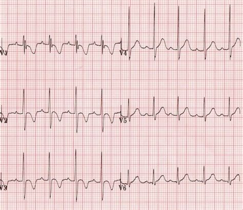 T Wave Litfl Ecg Library Basics
