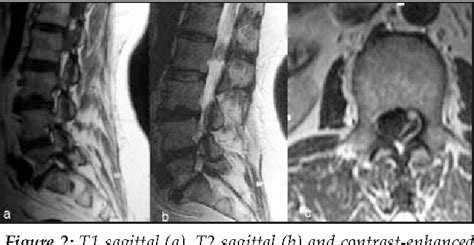 Figure 1 From Lumbar Spinal Chondroma Presenting With Radiculopathy