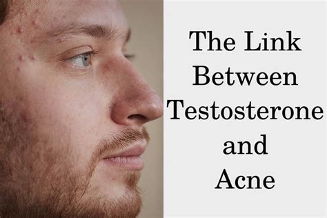 Is Testosterone A Cause Of Your Acne Hrtguru
