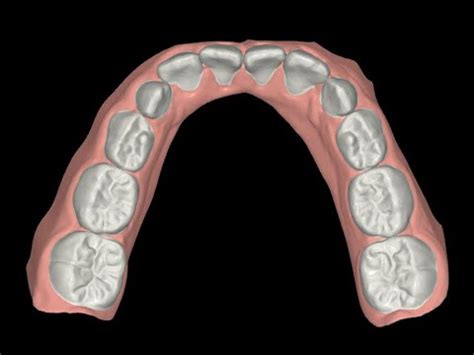 Análise da dentição mista de MOYERS utilizando modelos virtuais YouTube