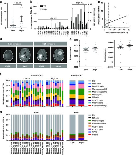 Tumor Invasiveness In Ts Matched Gbm Patients A D Tumor Invasiveness