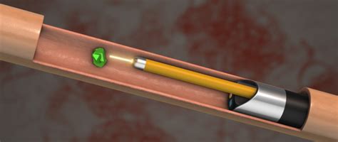 Standardizing High Frequency In Laser Lithotripsy