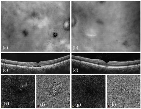 Multimodal Imaging In A 54 Year Old Female With Chronic Central Serous