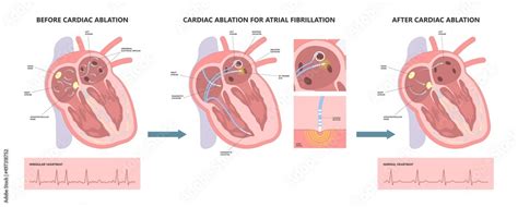Atrial Fibrillation Minimally Invasive Procedure Attack Cardiac