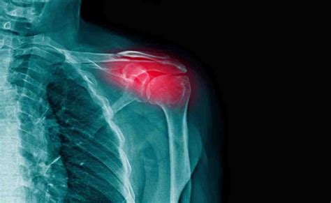 Adhesive Capsulitis Curezone Physiotherapy