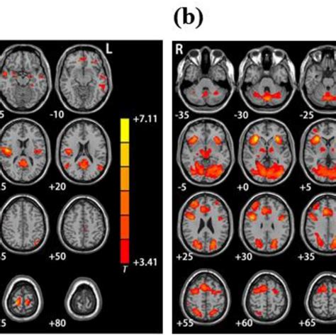 A The Activation Regions Of Pop Out Search Task In The Fmri B The
