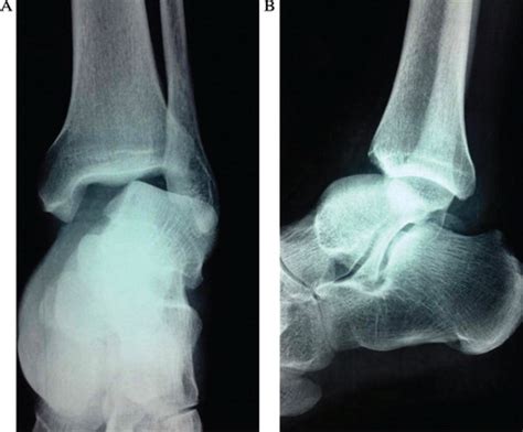 Ankle Dislocation Without Fracture