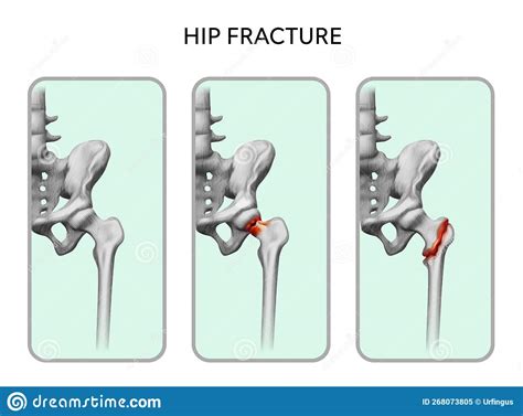 Fracture Of The Femoral Neck Vector Stock Vector Illustration Of
