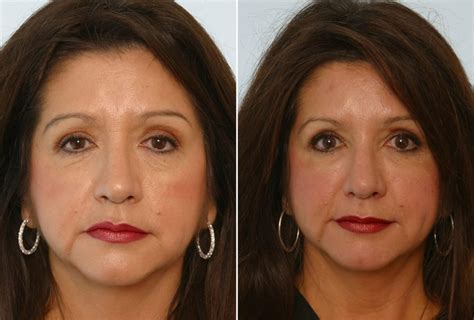 Restylane Lyft Messina Esthetic Medicine