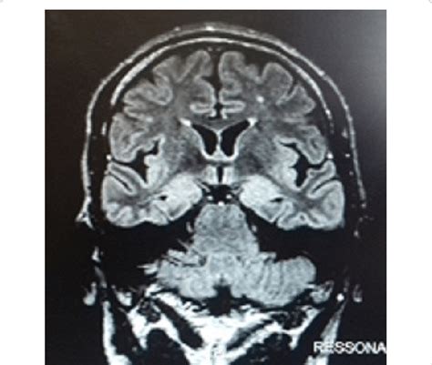 Sequence Axial T2flair Showing Areas Of Hyperintensity In The Region