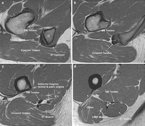 Hamstring Anatomy Mri