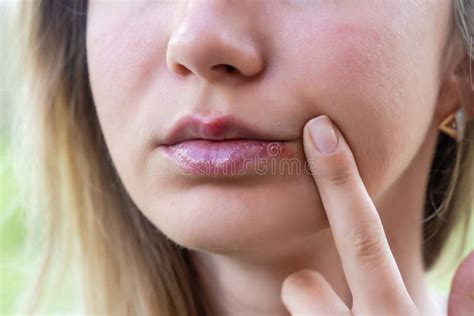 Herpes On The Lips Of Young Woman Close Up Stock Image Image Of