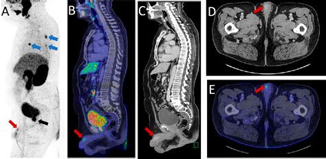Figure 1 From A Case Of Penile Metastasis From Prostate Cancer