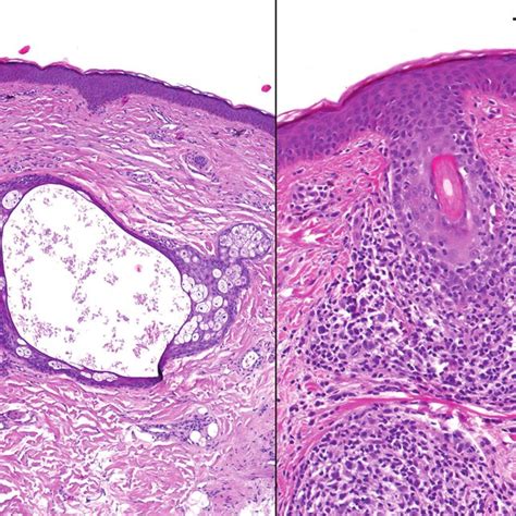 Haematoxylin Eosin Stained Skin Biopsy Specimen Left Comedolike