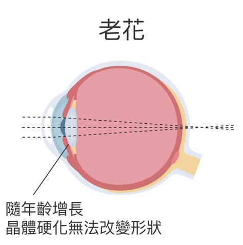 老花成因和老花治療方法 ｜清晰眼科 Clarity Eye Centre