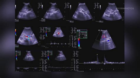 Ovarian Cancer Prevention