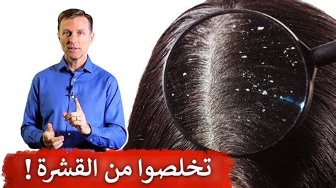 كيف نتخلص من القشرة دون رجعة Youtube