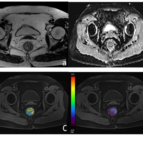 Performance Of Models For Predicting Plvi Positive Rectal Cancer Download Scientific Diagram