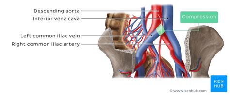 Iliac Vein Compression Syndrome Case With Images Kenhub