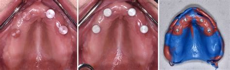 Novaloc A First Choice System For Overdentures Spear Education