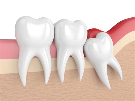 Things To Expect During And After Wisdom Teeth Removal