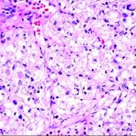 Diffusion Weighted Image Of Perivascular Epithelioid Cell Tumor Black