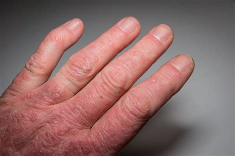 What Is Psoriatic Disease Psoriasis Australia