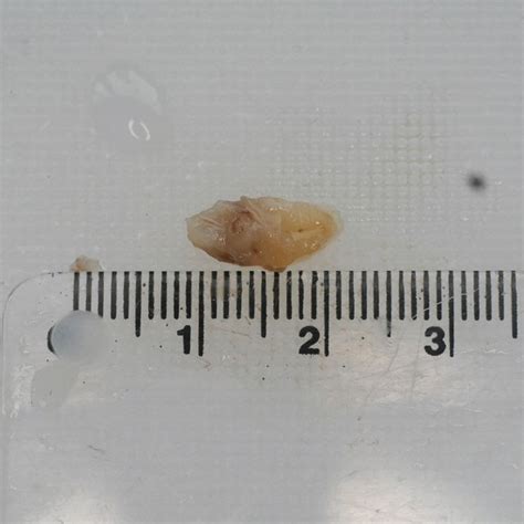 Macroscopic Examination Of The Incisional Biopsy Specimen Showing A Tan