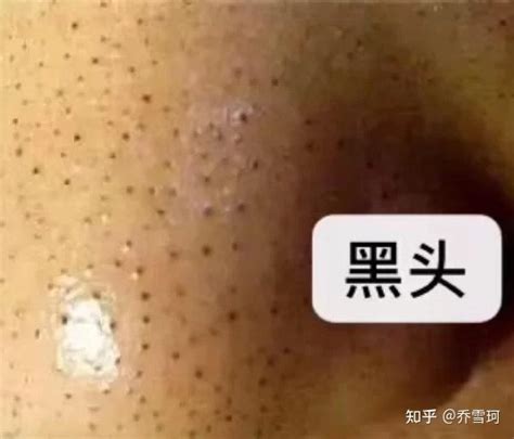 你的黑头不一定是黑头哦！ 知乎