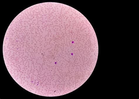 Vista Microscópica Del Portaobjetos Hematológico En El Laboratorio