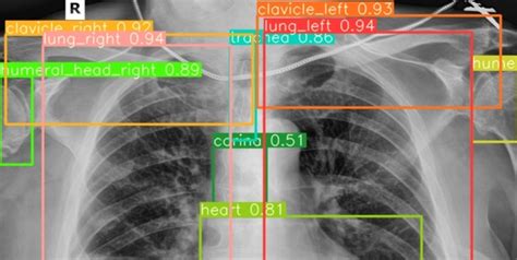 Yolov5 Chest Anatomy Detection Training Data Kaggle