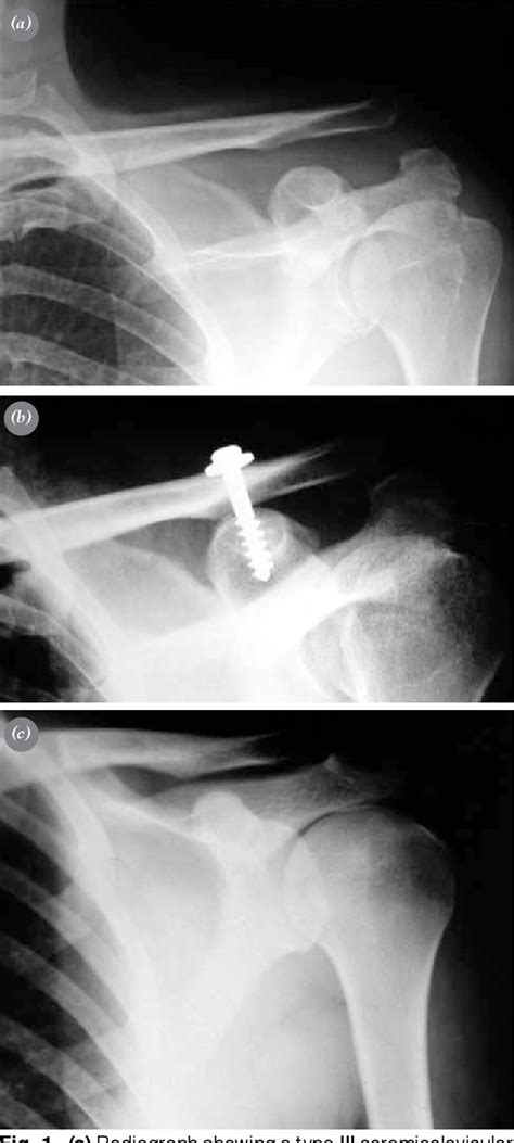 Coracoclavicular Ligament Semantic Scholar