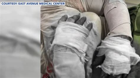 Number Of Fireworks Related Injuries Higher Than 2023 In Metro Manila