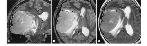 Lower Convexity Meningioma 52 Year Old Female A B Fast Stir Images