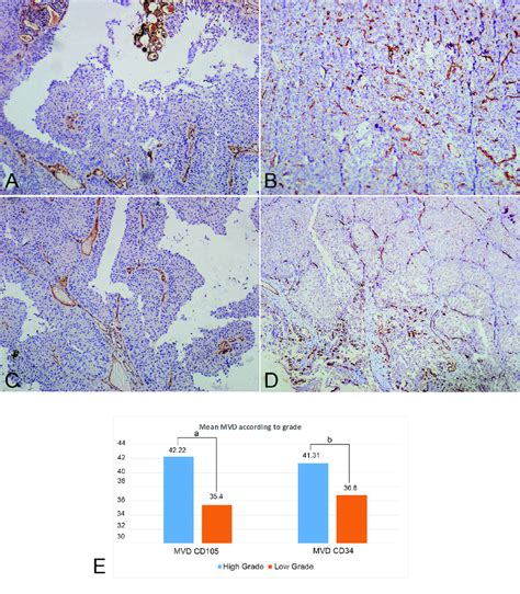 Cd105 And Cd34 Tissue Expression In Low And High Grade Urothelial