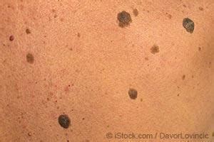 How Long Do Genital Warts Last