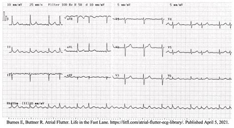 Emergency Medicine Educationem 3am Atrial Flutter Emergency